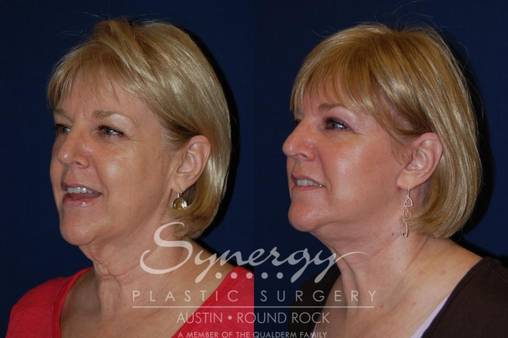 Facelift Before and After Pictures Case 128 | Austin, TX | Synergy ...