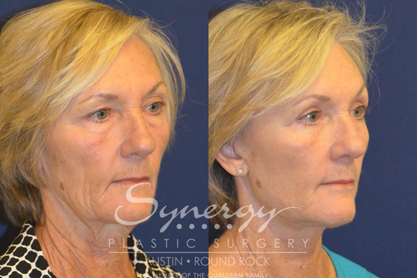 Facelift Before and After Pictures Case 367 | Austin, TX | Synergy ...