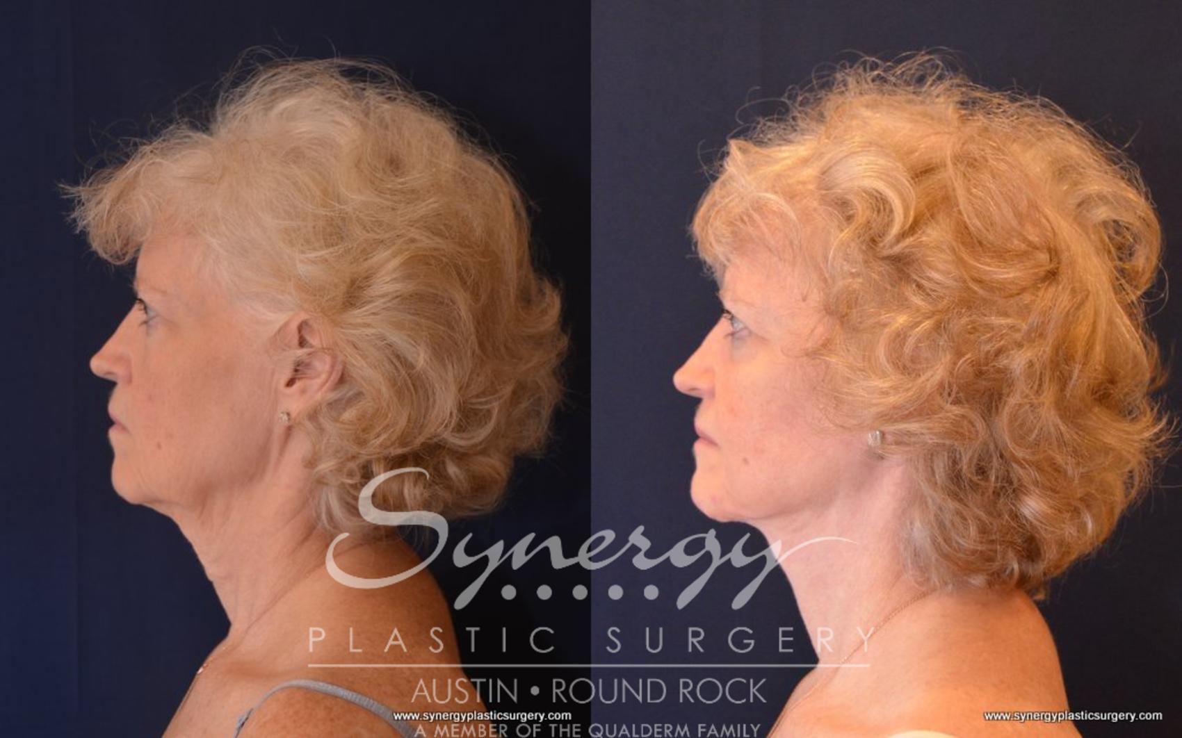 Facelift Before and After Pictures Case 498 | Austin, TX | Synergy ...