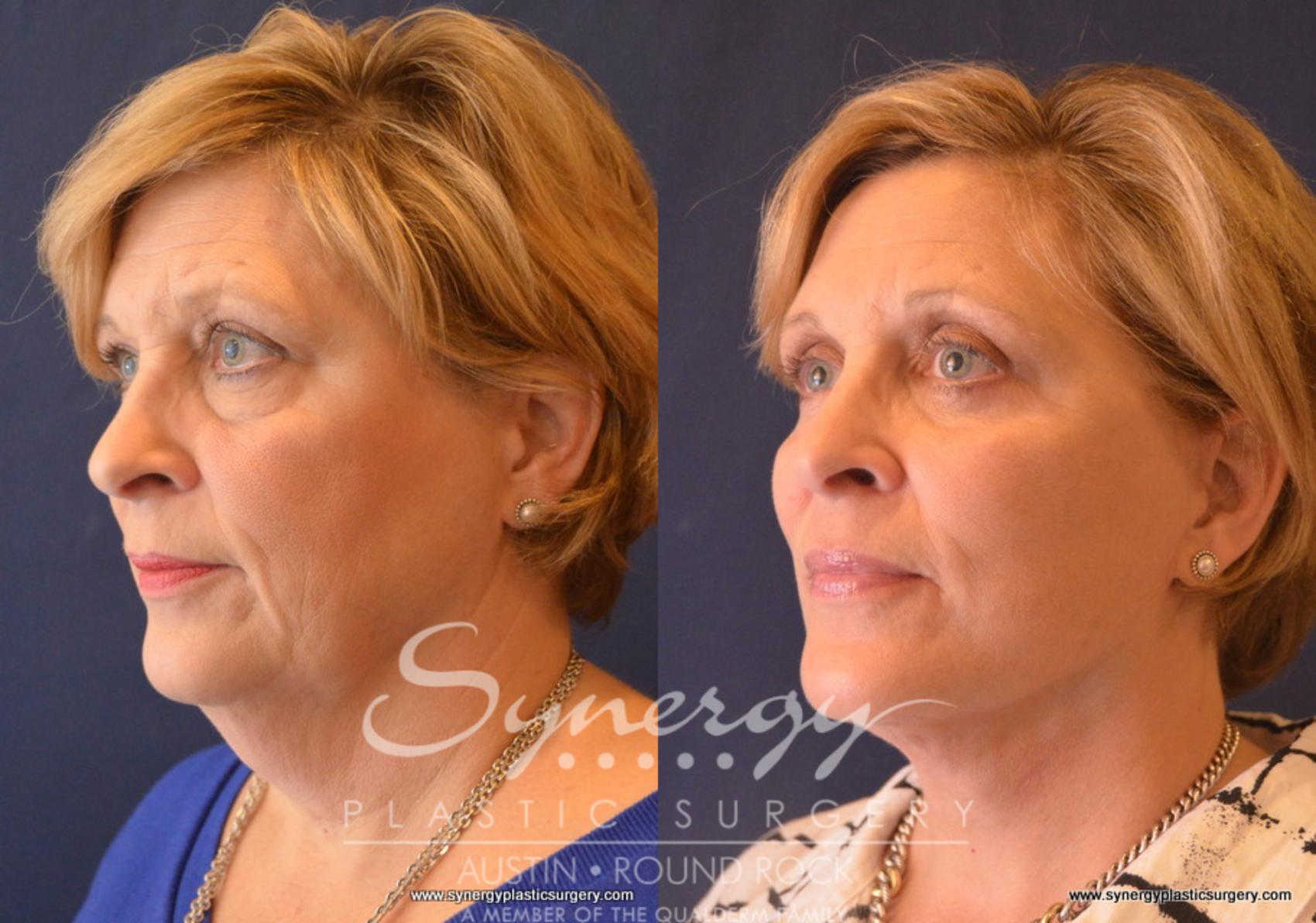 Facelift Before and After Pictures Case 658 | Austin, TX | Synergy ...