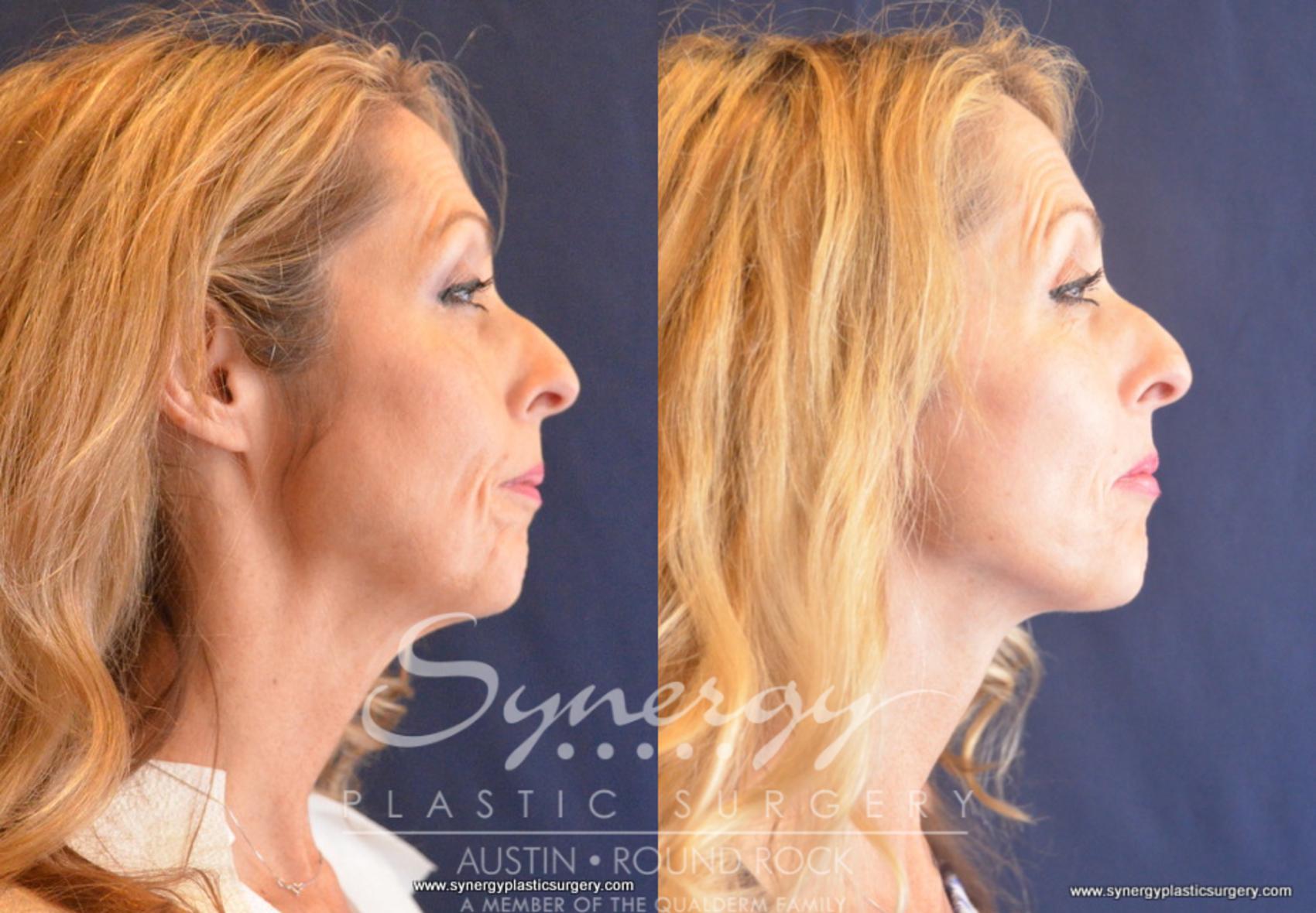 Facelift Before and After Pictures Case 680 | Austin, TX | Synergy ...