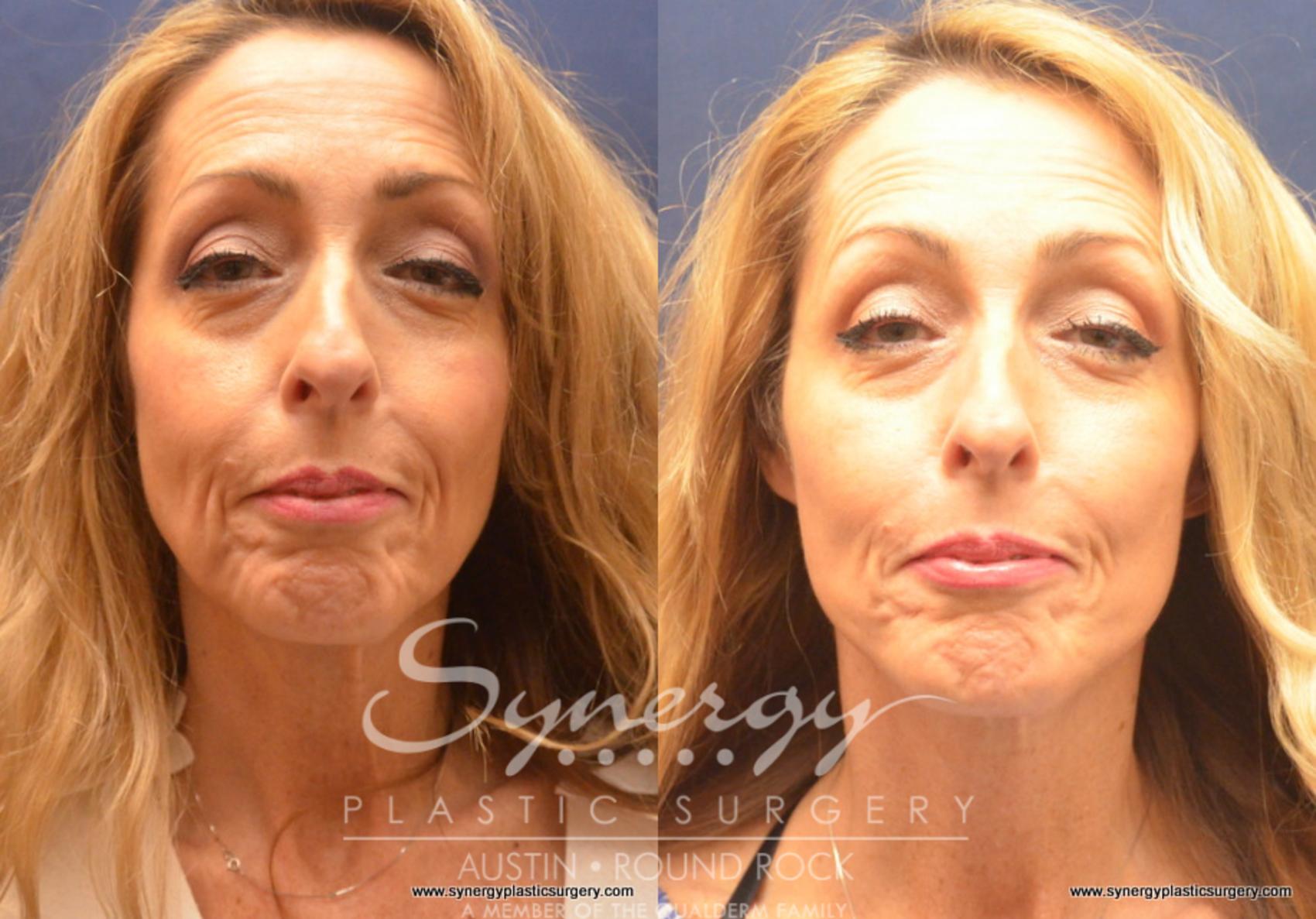 Facelift Before and After Pictures Case 680 | Austin, TX | Synergy ...