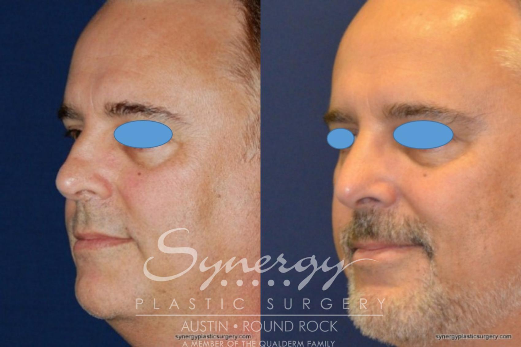Rhinoplasty Before And After Pictures Case 209 Austin Tx Synergy Plastic Surgery
